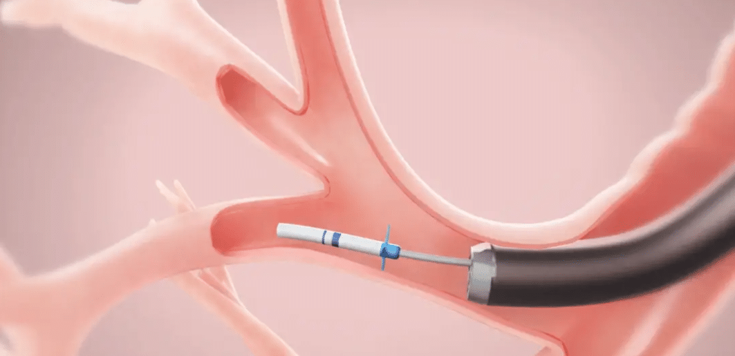 Aetna Now Covers Zephyr Valve for Bronchoscopic LVRS in Patients with ...